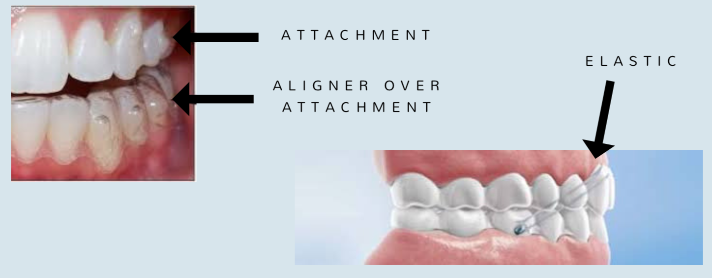 FAQs - Robbinsville Orthodontics